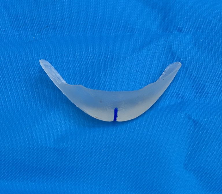 Plastic Surgery Case Study - Female Medpor Chin Implant Replacement ...