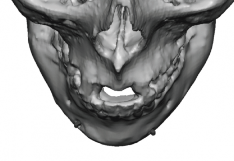 female medpor chin implant 3D CT scan 1 top view Dr Barry Eppley ...