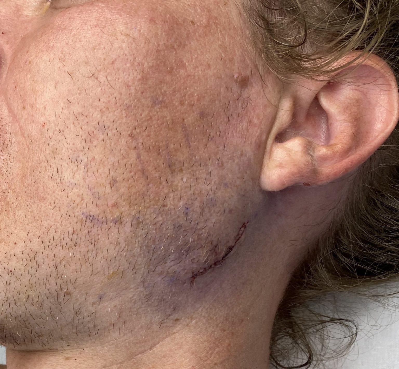 Plastic Surgery Case Study - Direct Transcutaneous Repair of Masseteric ...