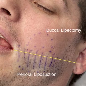 cheek reduction Archives - Explore Plastic Surgery