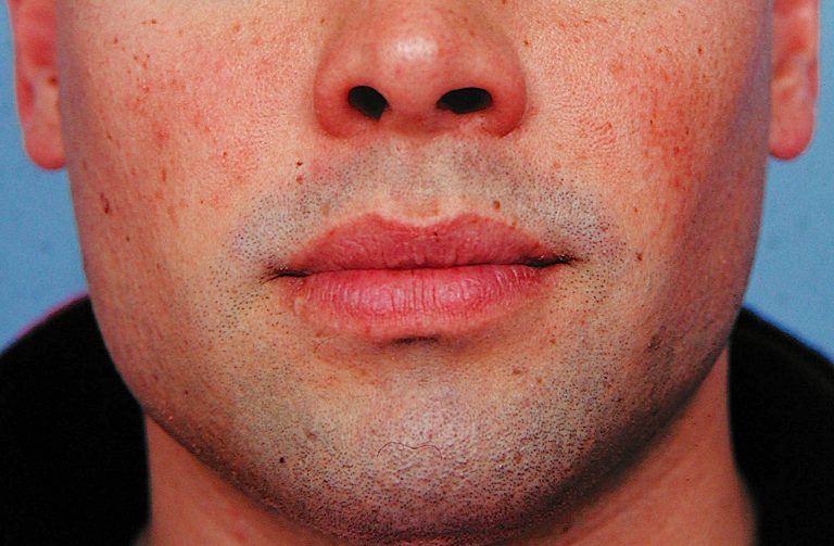 The Anatomy and Aesthetic Significance of the Buccal Lipectomy in ...