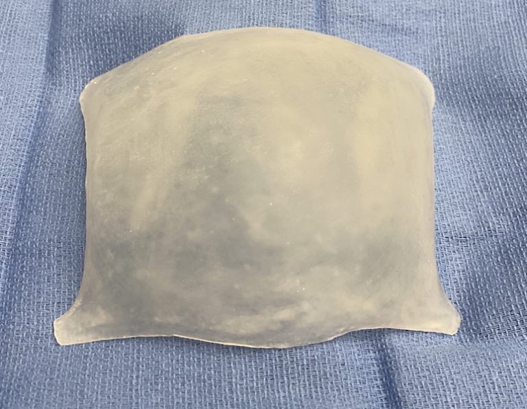 Plastic Surgery Case Study - Combined Sagittal Crest Skull Reduction ...