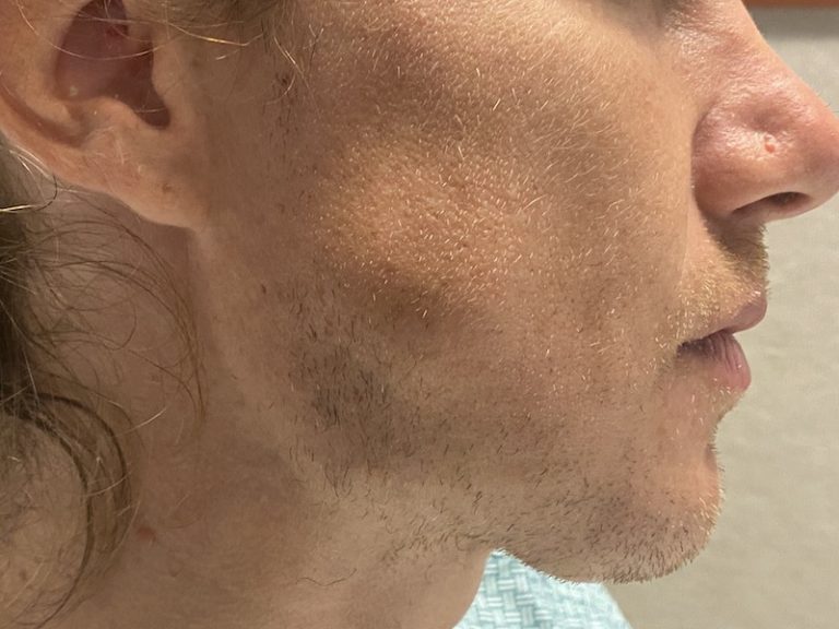 Plastic Surgery Case Study - Direct Transcutaneous Repair of Masseteric ...