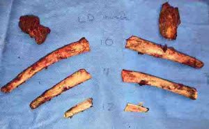 The Five Critical Steps in Waistline Narrowing By Rib Removal Surgery ...