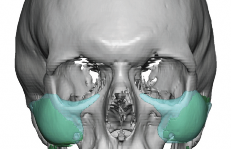 Plastic Surgery Case Study - Custom Midface Implant Replacements for ...