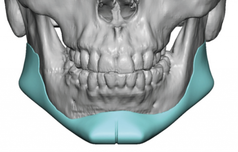 Plastic Surgery Case Study - Custom Jawline Implant for the High Angle ...