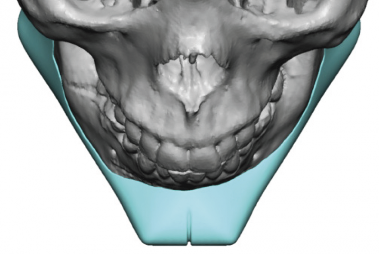 Plastic Surgery Case Study - Custom Jawline Implant for the High Angle ...