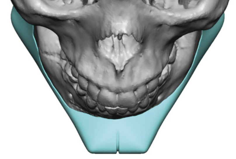 Plastic Surgery Case Study - Custom Jawline Implant for the High Angle ...
