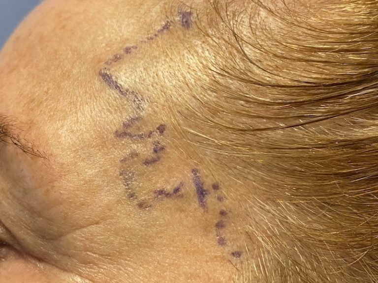 Plastic Surgery Case Study - Ligations of Prominent Superficial ...