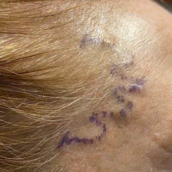 temporal artery ligation Archives - Page 2 of 5 - Explore Plastic Surgery