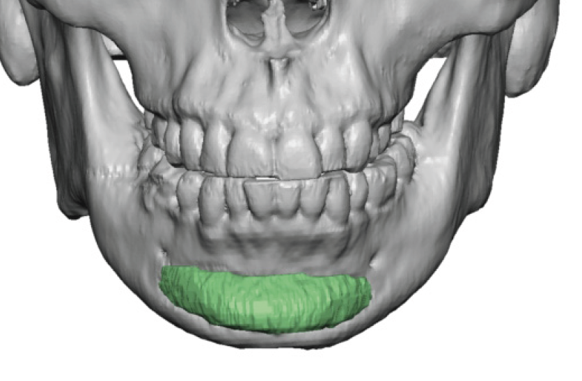 Plastic Surgery Case Study - Custom Jawline Implant for the High Angle ...