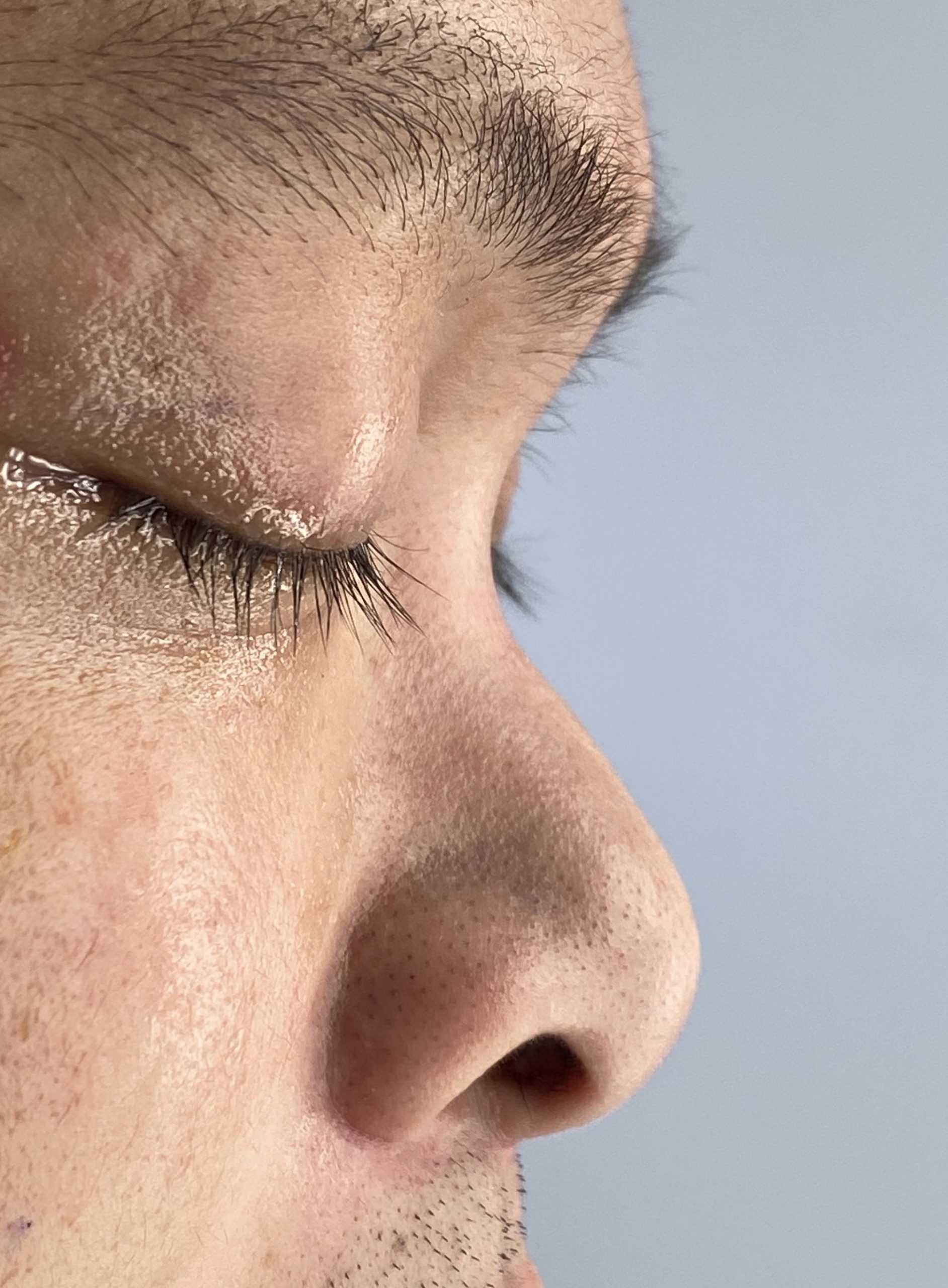 Plastic Surgery Case Study - Secondary Nasal Augmentation of the Short ...