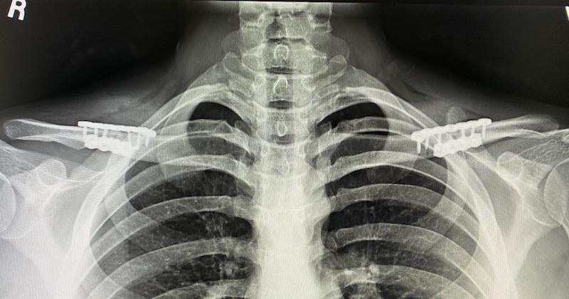 Plastic Surgery Case Study - Outcome Assessment of Transgender Male to ...