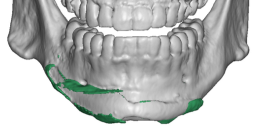 Understanding the Natural Biologic Reactions of Bone to Chin Implants ...