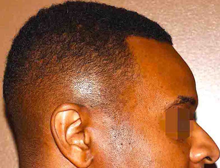 Technical Strategies - Incisional and Placement Approaches for Custom ...