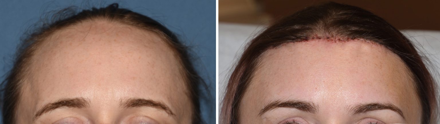 Dual Forehead Reshaping with the Combination of Hairline Advancement ...