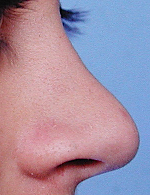 The Use of Alar Contour Septal Grafts in Alar Rim Retraction in ...