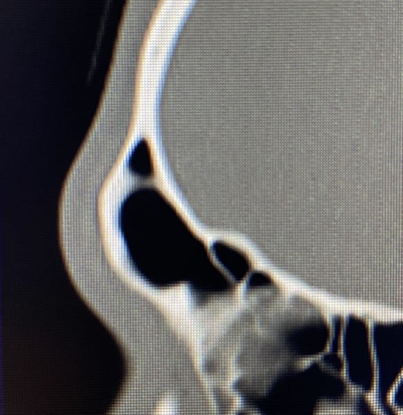 A CT Scan Analysis of Brow Bone Reduction - Indications for Shaving vs ...