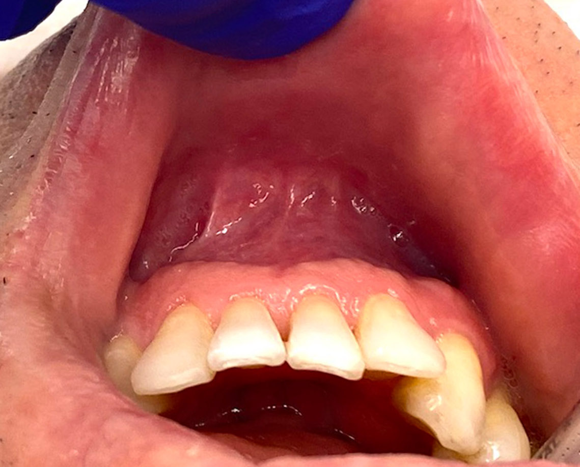 Technical Strategies - The Role of Vestibular Shortening in Chin Ptosis ...