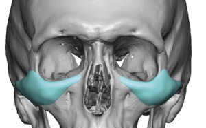 Technical Strategies - The Hemi Lower Blepharoplasty Incision for ...