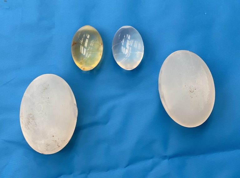 Plastic Surgery Case Study - Custom Ultrasoft Testicle Implant ...