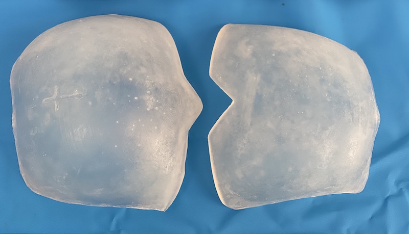 Plastic Surgery Case Study - Male Custom Extended Forehead-Skull ...