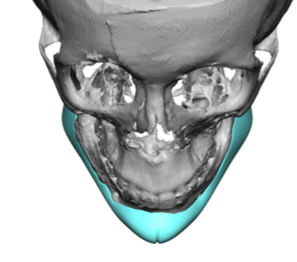 Plastic Surgery Case Study - Female Custom Jawline Implant for V Line ...