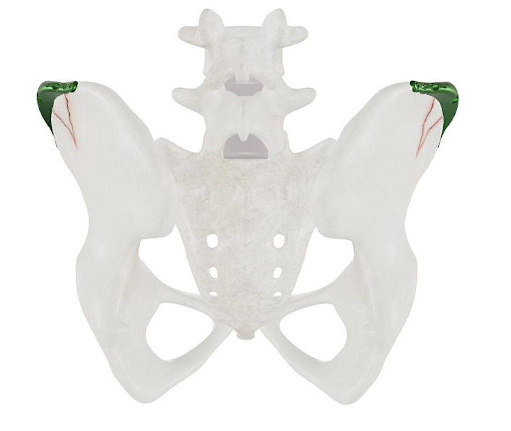 Hip Widening By Iliac Crest Bone Implant Augmentation - Concept and ...