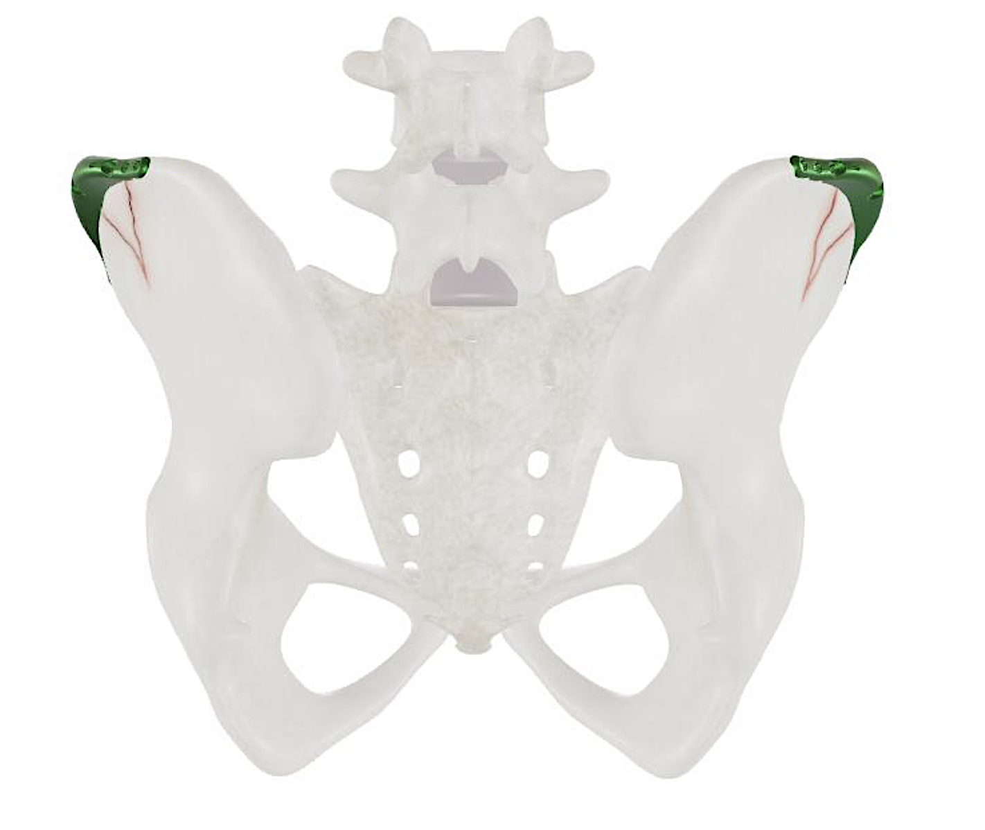 Hip Widening By Iliac Crest Bone Implant Augmentation - Concept and ...