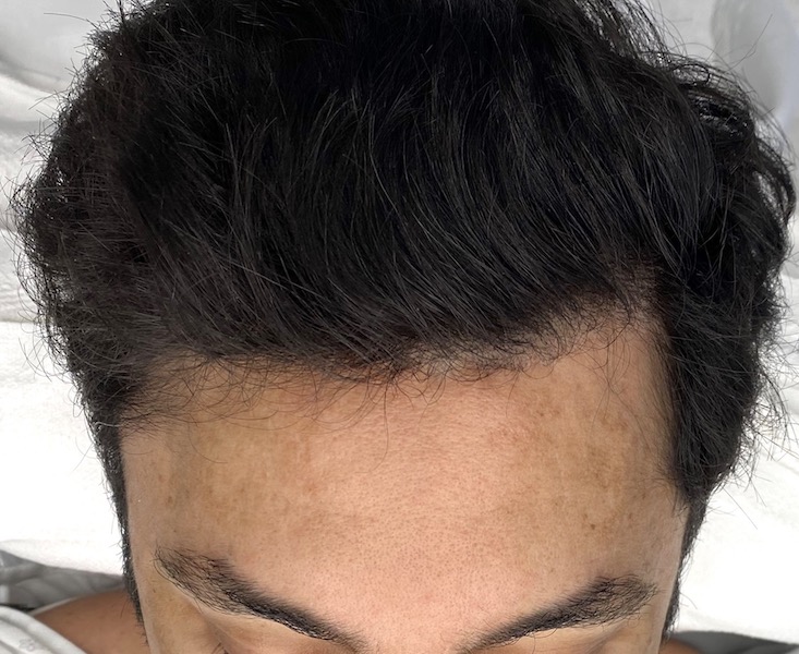 male custom forehead implant front 1 Dr Barry Eppley Indianapolis ...