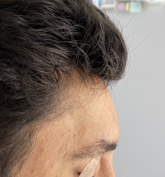 Plastic Surgery Case Study - Male Custom Extended Forehead-Skull ...