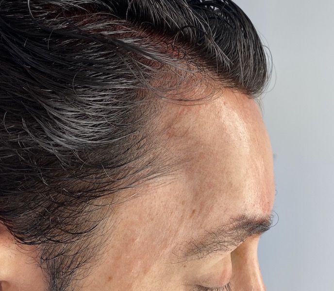 Plastic Surgery Case Study - Male Custom Extended Forehead-Skull ...