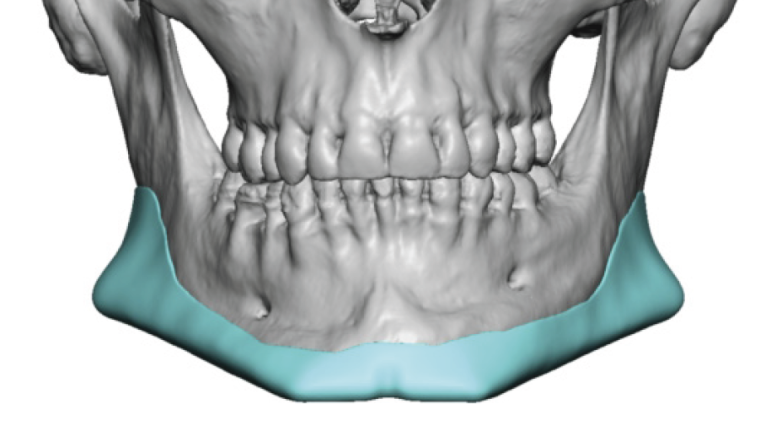 Plastic Surgery Case Study - Custom Wrap Around Jawline Implant in ...