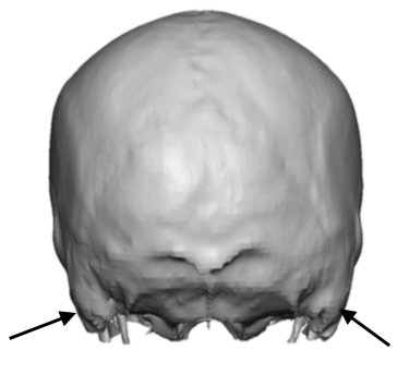 Plastic Surgery Case Study - Male Prominent Mastoid Process Reductions ...