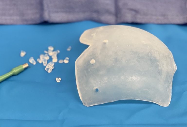 Plastic Surgery Case Study - Male Custom Extended Forehead-Skull ...