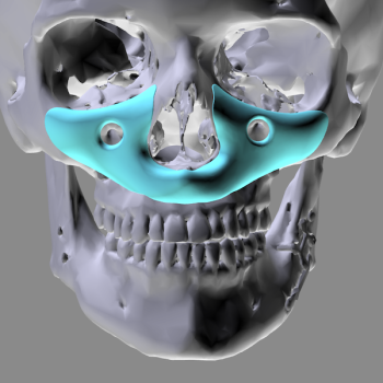 custom facial implants Archives - Page 5 of 48 - Explore Plastic Surgery
