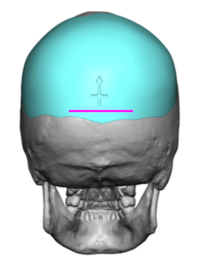 custom skull implant for flat back of head design Dr Barry Eppley ...