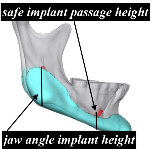 Plastic Surgery Case Study - Custom Jawline Implant Replacement ...