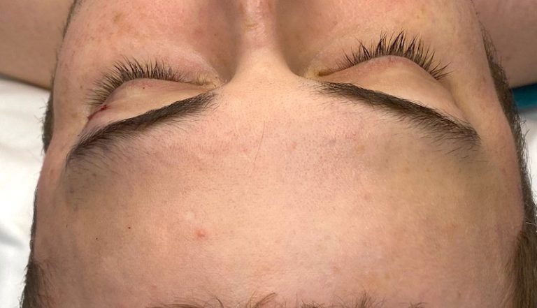 left brow bone protrusion and left temporal hollowing top view after Dr ...