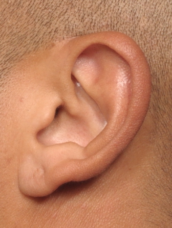 Plastic Surgery Case Study - Excision of Redundant Scalp Rolls Through ...