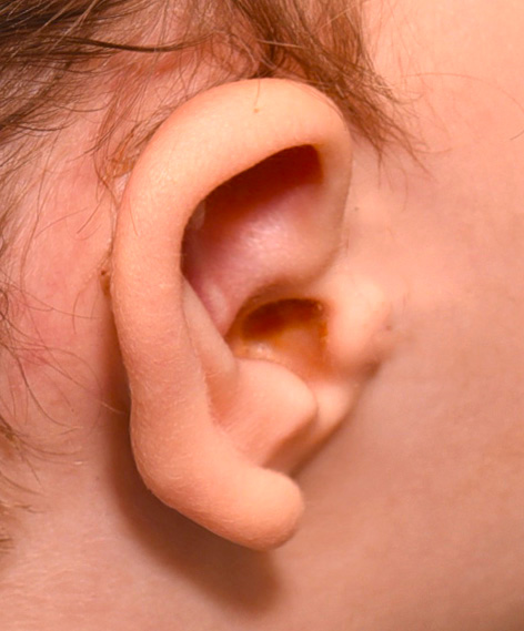 Plastic Surgery Case Study - Excision of Bilateral Preauricular Ear ...