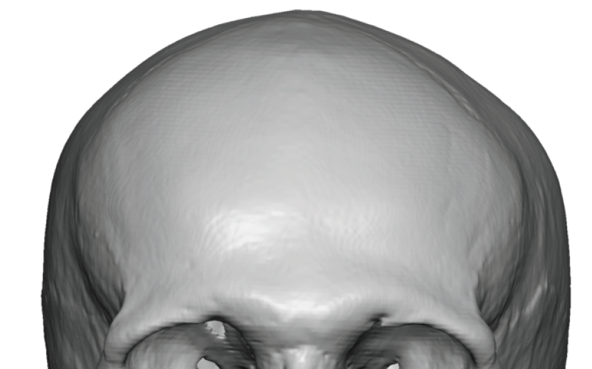 right forehead reduction 1 front view 3D Ct scan Dr Barry Eppley ...