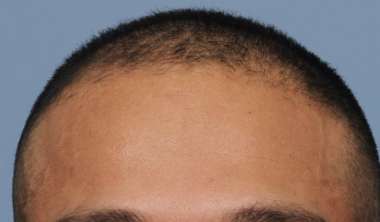 Plastic Surgery Case Study - Bony Forehead Protrusion Reduction in ...