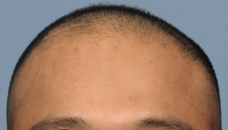 Plastic Surgery Case Study - Bony Forehead Protrusion Reduction in ...