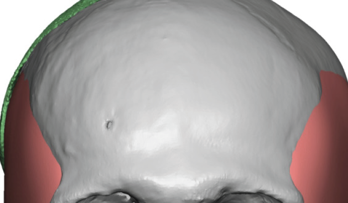 Plastic Surgery Case Study - Bony Forehead Protrusion Reduction in ...