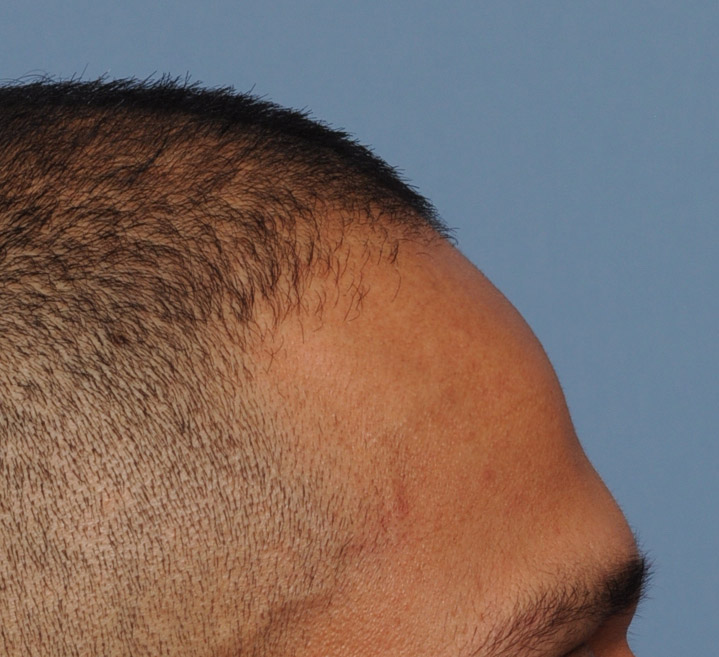 Plastic Surgery Case Study - Bony Forehead Protrusion Reduction in ...