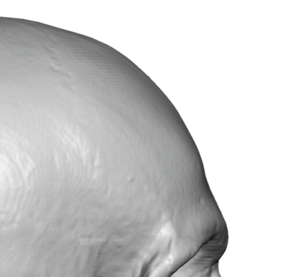 Plastic Surgery Case Study - Bony Forehead Protrusion Reduction in ...