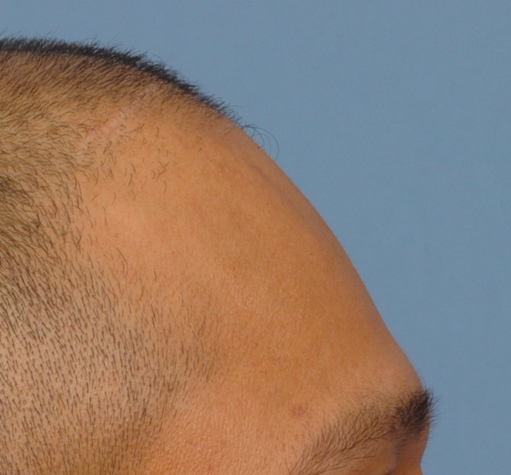 Plastic Surgery Case Study - Bony Forehead Protrusion Reduction in ...