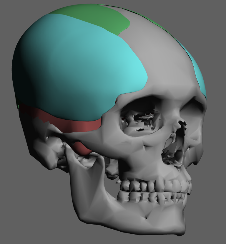 Plastic Surgery Case Study - Custom Extended Temporal-Forehead Implants ...