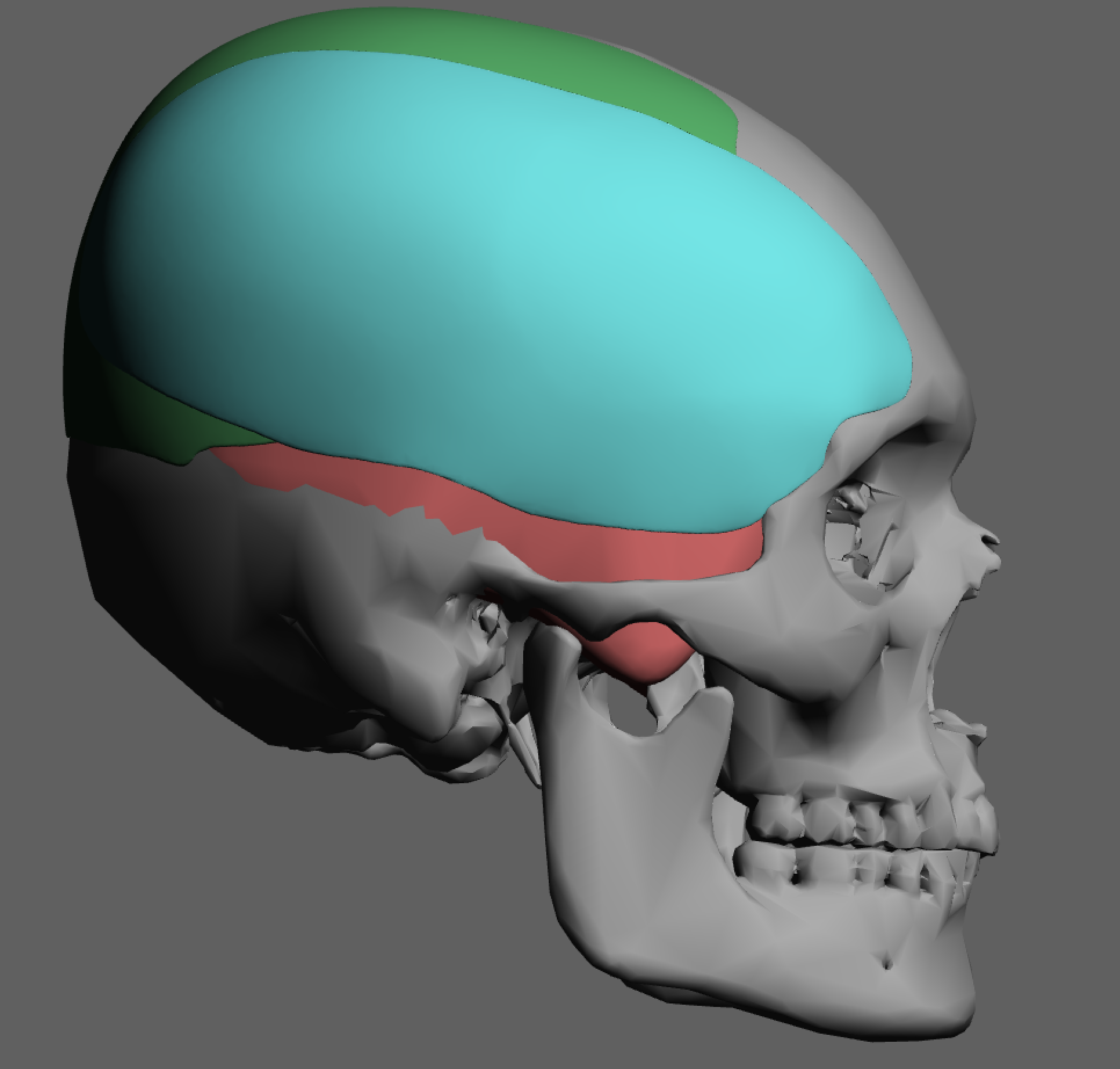 Plastic Surgery Case Study - Custom Extended Temporal-Forehead Implants ...